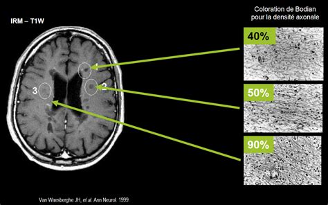 Aspect Irm Des Lésions De Sep