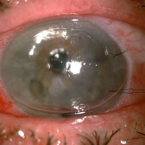 A Anterior Segment Oct Done On Day 1 After Cataract Surgery Showing