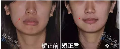 嘴巴突显老，天生法令纹，少女感绝缘到底怎么办？ 贝致——专业口腔服务平台，让你变美的牙套交流社区