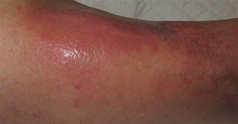 Dermapixel Lipodermatoesclerosis La Celulitis Que Nunca Fue