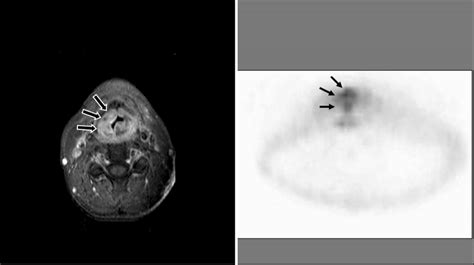 Patient 5 Mri Stir Axial With Diffuse Paraglottic Swelling On Both