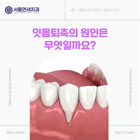 잇몸 퇴축의 원인 안양서울연세치과에서 전부 알려드릴게요 😮 경기도 안양시 동안구 비산동 치과의원 당근 비즈 소식