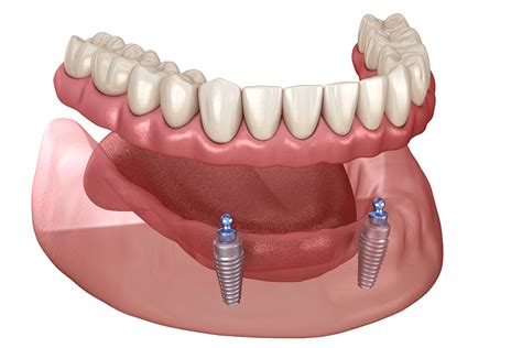 Denture Stabilization With Dental Implants Institute For Advanced