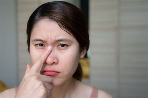 Jerawat Di Alis Ini 6 Penyebab Dan Cara Jitu Mengatasinya
