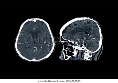 Ct Scan Brain Axial Sagittal Plane Stock Photo Shutterstock