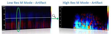 Emboli Detection Hits Detection With Tcd Monitoring