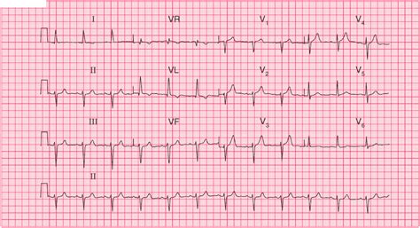 Ecg Case 51 Left Anterior Fascicular Block Lafb And Left Ventricular