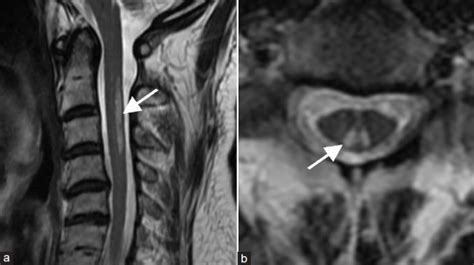 Spinal Mr Imaging In Vitamin B12 Deficiency Case Series Differential