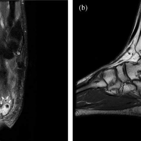 Pdf Partial Calcanectomy And Ilizarov External Fixation May Reduce