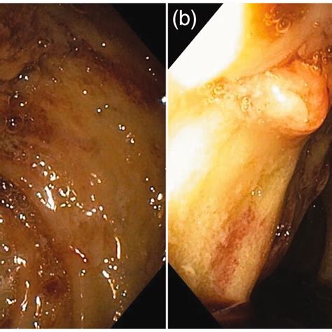 A Duodenoscopy Showing Diffusely Altered Wall Of The Duodenum With Download Scientific