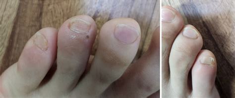 셀라큐어 발톱 솔루션 내돈내산 리얼 효과 가격 할인 이벤트 Loyal It