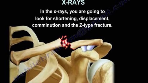 Clavicle Fractures Everything You Need To Know Dr Nabil Ebraheim