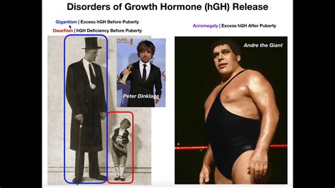 Gigantism Before And After