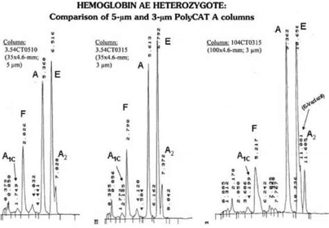 Hemoglobin Variant Analysis Zodiac Life Sciences