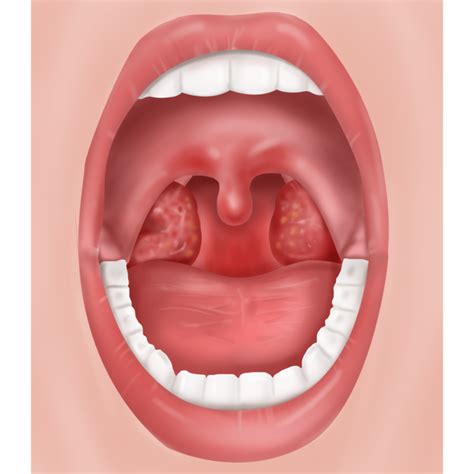 입안수포 입안헐었을때 입안염증 원인 네이버 블로그