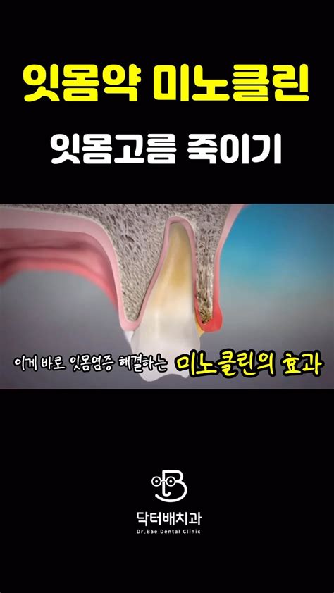 잇몸성형 잇몸치료 잇몸전문치과 임플란트 하기전 자기치아살리기 원한다면 잇몸치료 받고 미노클린 엠도게인 사용해서