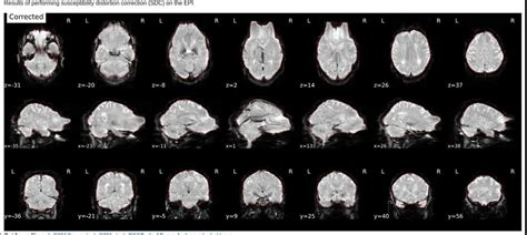 Elongated Brain Errors In Fmriprep Susceptibility Distortion Correction Software Support