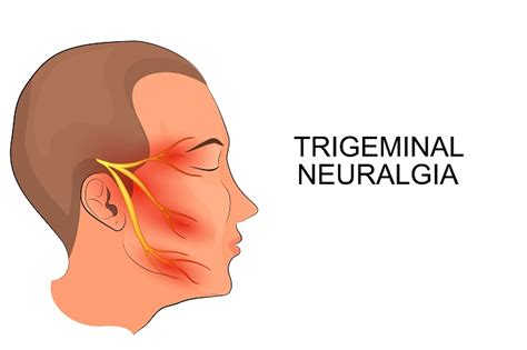 Penatalaksanaan Trigeminal Neuralgia Alomedika