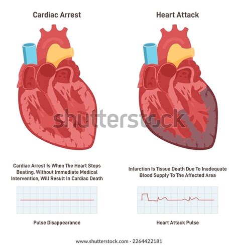 Cardiac Arrest Vs Heart Attack Heart Stock Vector Royalty Free