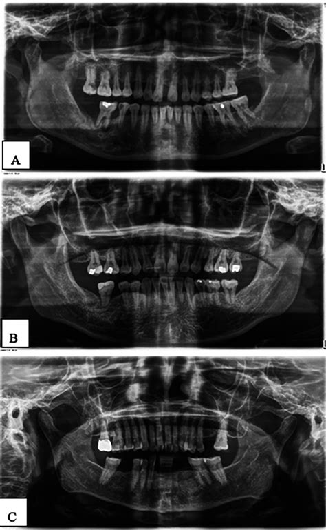 Advanced Ai Assisted Panoramic Radiograph Analysis For Periodontal Prognostication And Alveolar
