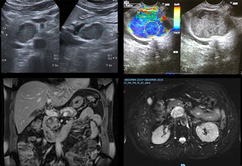 A Abdominal Ultrasound Round Hypoechoic Lesion In Uncinate Process