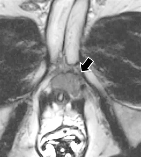 Imaging Of The Bulbourethral Cowper Gland Abnormalities And