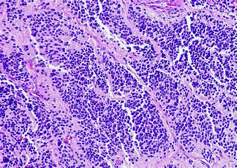 Y Mabs Down 19 On Fda Briefing Docs On Omburtamab But Bofa Still