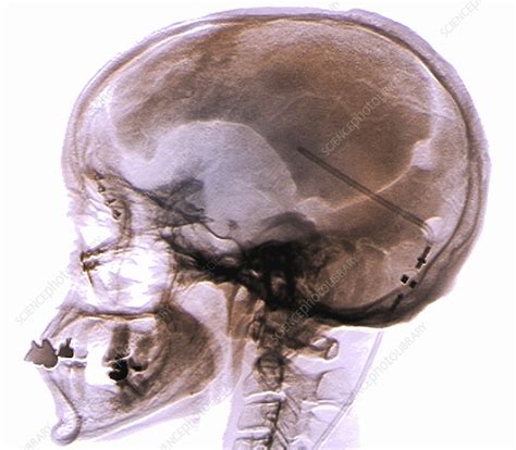 Ventricular Shunt X Ray Stock Image C0269882 Science Photo Library
