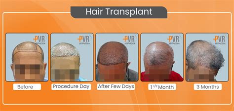 Best Hair Transplant Doctor In Navi Mumbai PVR Aesthetica