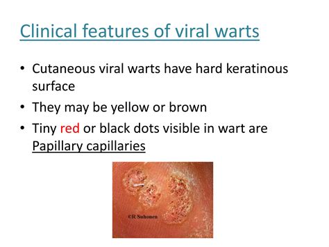 Viral Warts Ppt