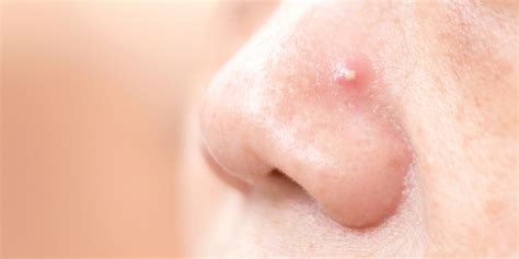 Zits On Face Causes Treatment Prevention Tips
