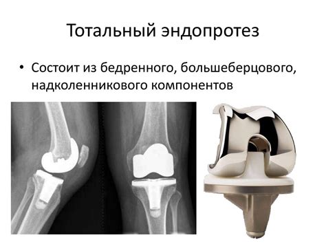 Эндопротезирование тазобедренного коленного суставов презентация онлайн