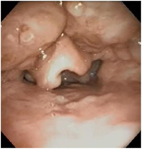 Lingual Tonsil Hypertrophy Visualized On Sleep Endoscopy Download