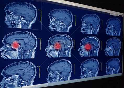 Mri