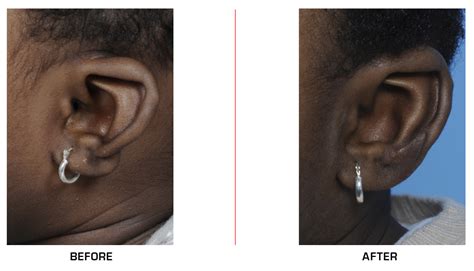 Ear Reconstruction Gallery