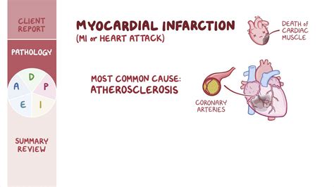 Mi Nursing Care Plan Myocardial Infarction Nursing Plan 49 Off