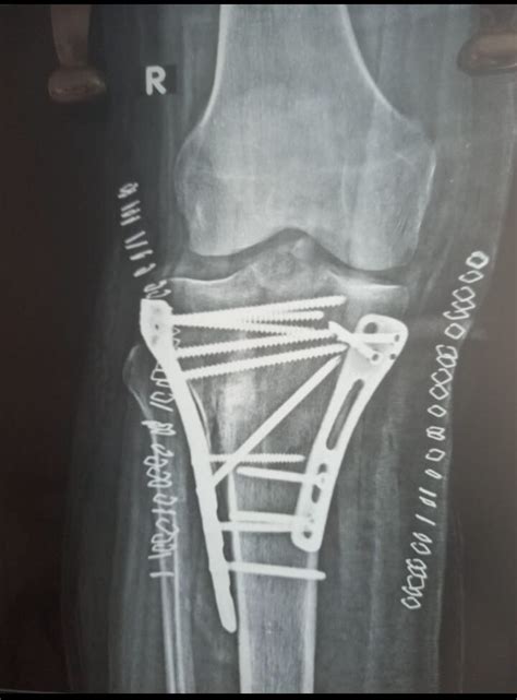 Dr 30 Year Old Young Male Patient With Right Bicondylar Proximal Tibia Fracture Operated With