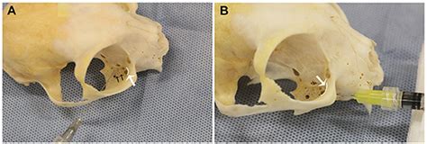 Maxillary Nerve Block High Tuberosity Approach