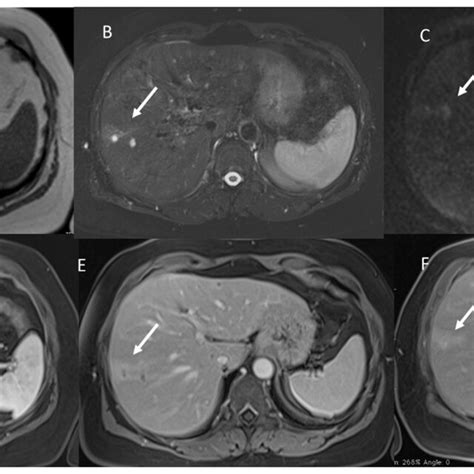 Mucinous Liver Metastasis Arrow On Vii Viii Hepatic Segment In A