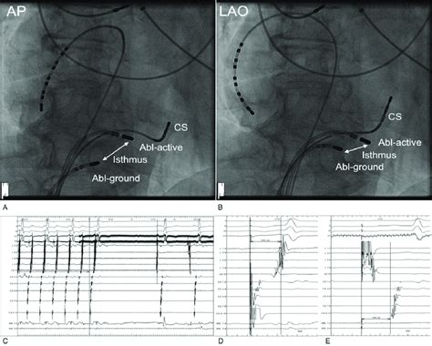 Bipolar Ablation Of The Cavo Tricuspid Isthmus Dependent Atrial Flutter Download Scientific
