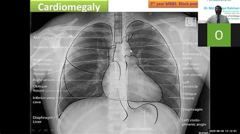 How To Detect Cardiomegaly On Chest X Ray At Kathleen Dekker Blog