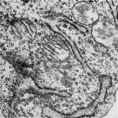 Tumor Cell With Numerous Dilated Cisternae Of Endoplasmic Reticulum