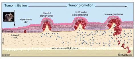 Malignant Tumor Structure A A Schematic View Adapted