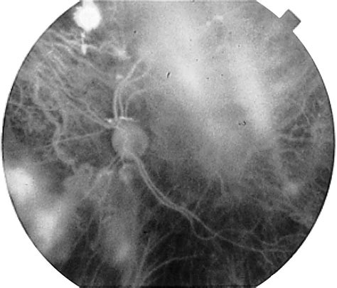 Fluorescein Angiography Photograph In The Left Eye Shows Prominent Download Scientific Diagram