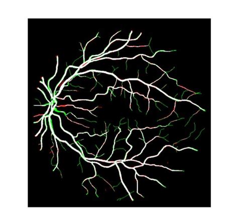 Machine Learning Assignment Diabetic Retinopathy
