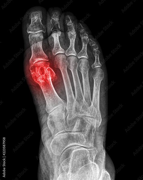 First Metatarsal Fracture