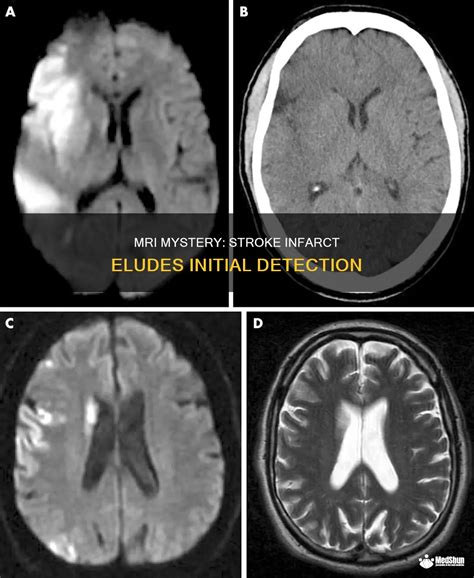 Mri Mystery Stroke Infarct Eludes Initial Detection Medshun