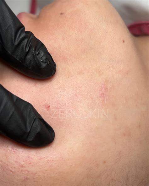 대한민국 여드름은 제로스킨홍대피부관리아나픈 여드름압출대표원장 유화영 예뻤어 제로스킨에서 예뻤던 피부로 돌아가보자🌈 입주변 가득찬 좁쌀여드름 생리전후 반복되는