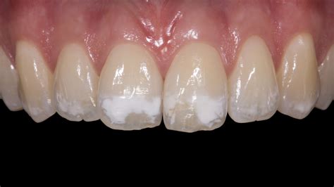 White Spots Removal And Volume Restitution