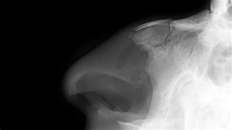 Xray Pictures Of Broken Nose Xray Pictures